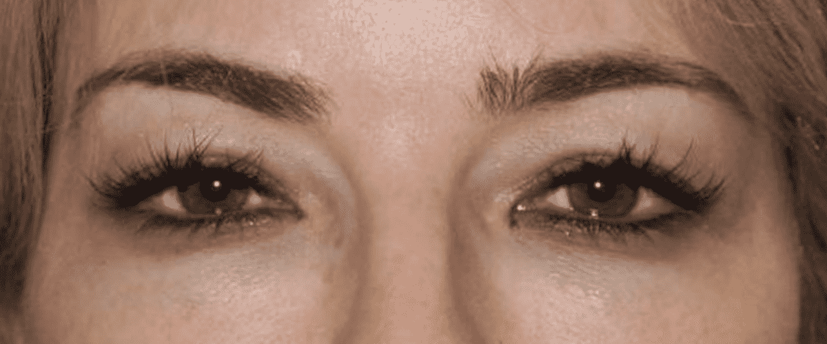Cosmetic Reconstructive & Plastic Eye Surgery | TX & FL